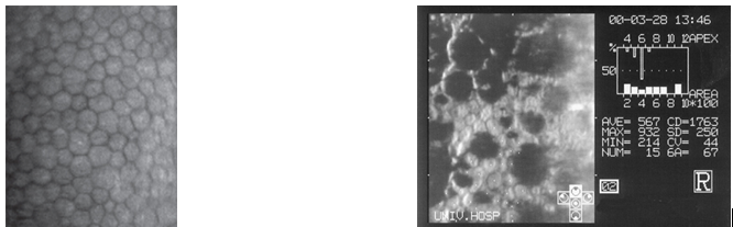 Fuchs ενδοθηλιακή δυστροφία κερατοειδούς - Δρ Κ. Καραμπάτσας ...