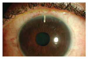 Express shunt - Κωνσταντίνος Χ. Καραμπάτσας - Χειρουργός Οφθαλμίατρος