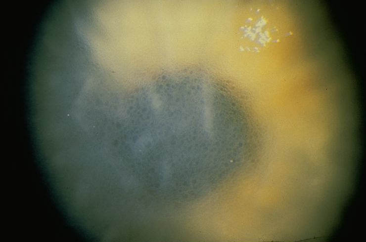 Fuchs ενδοθηλιακή δυστροφία κερατοειδούς - Δρ Κ. Καραμπάτσας ...